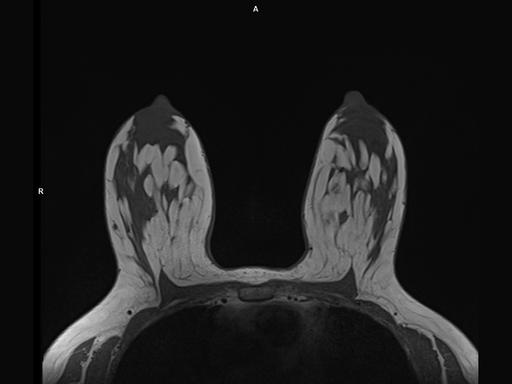 NeoCoil - Siemens Healthineers USA