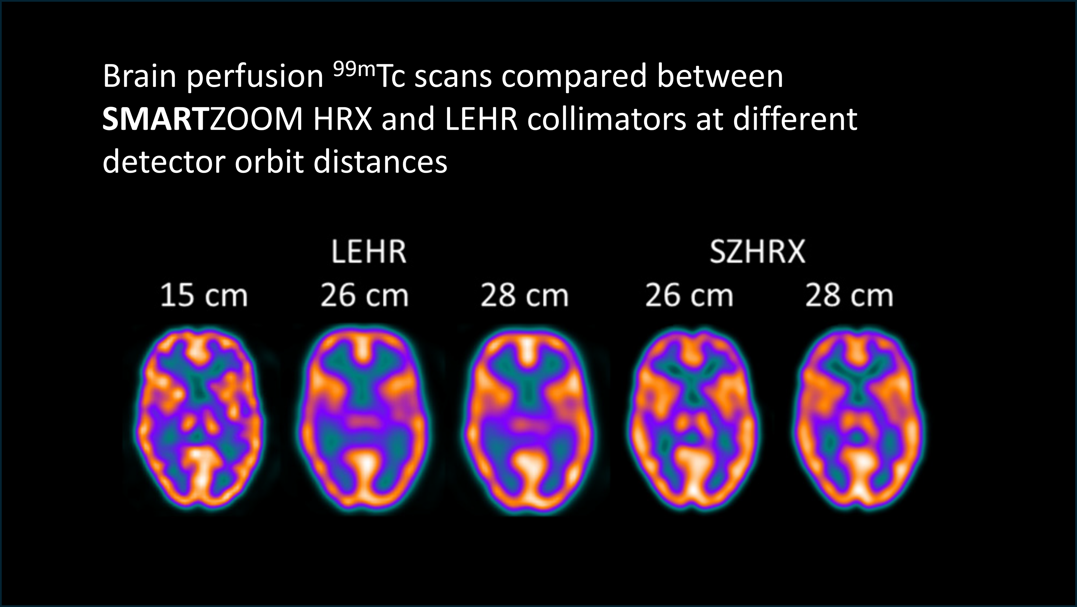 SMARTZOOM HRX: Applications and benefits in SPECT and SPECT/CT brain ...