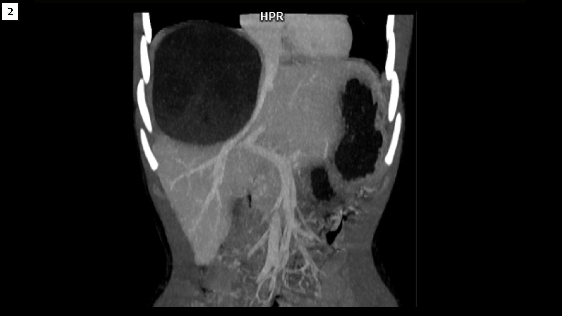 Cystic echinococcosis in a child - Siemens Healthineers