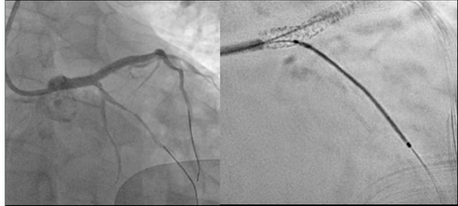 Enhanced stent visualization assists in improving the outcome of ...