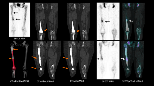 Symbia Pro.specta SPECT/CT Case Study Review - Siemens Healthineers USA