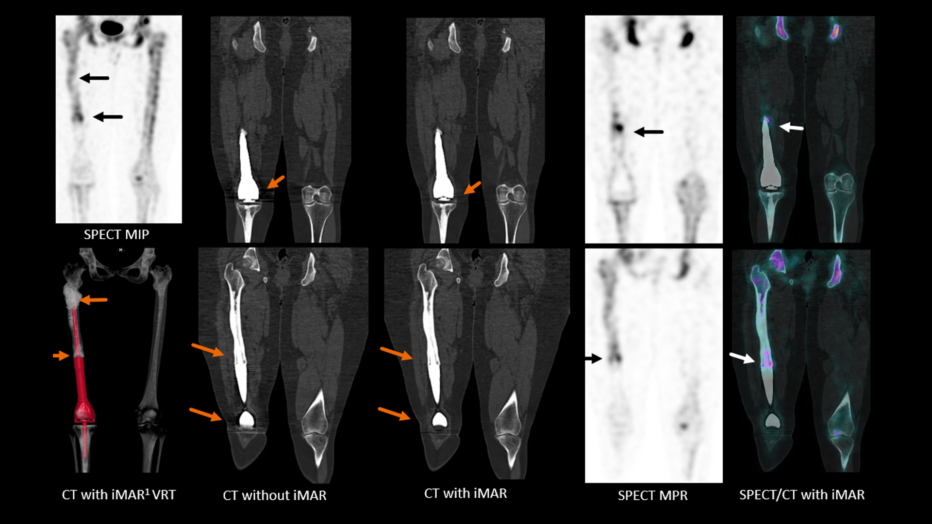 Symbia Pro.specta SPECT/CT Case Study Review - Siemens Healthineers USA