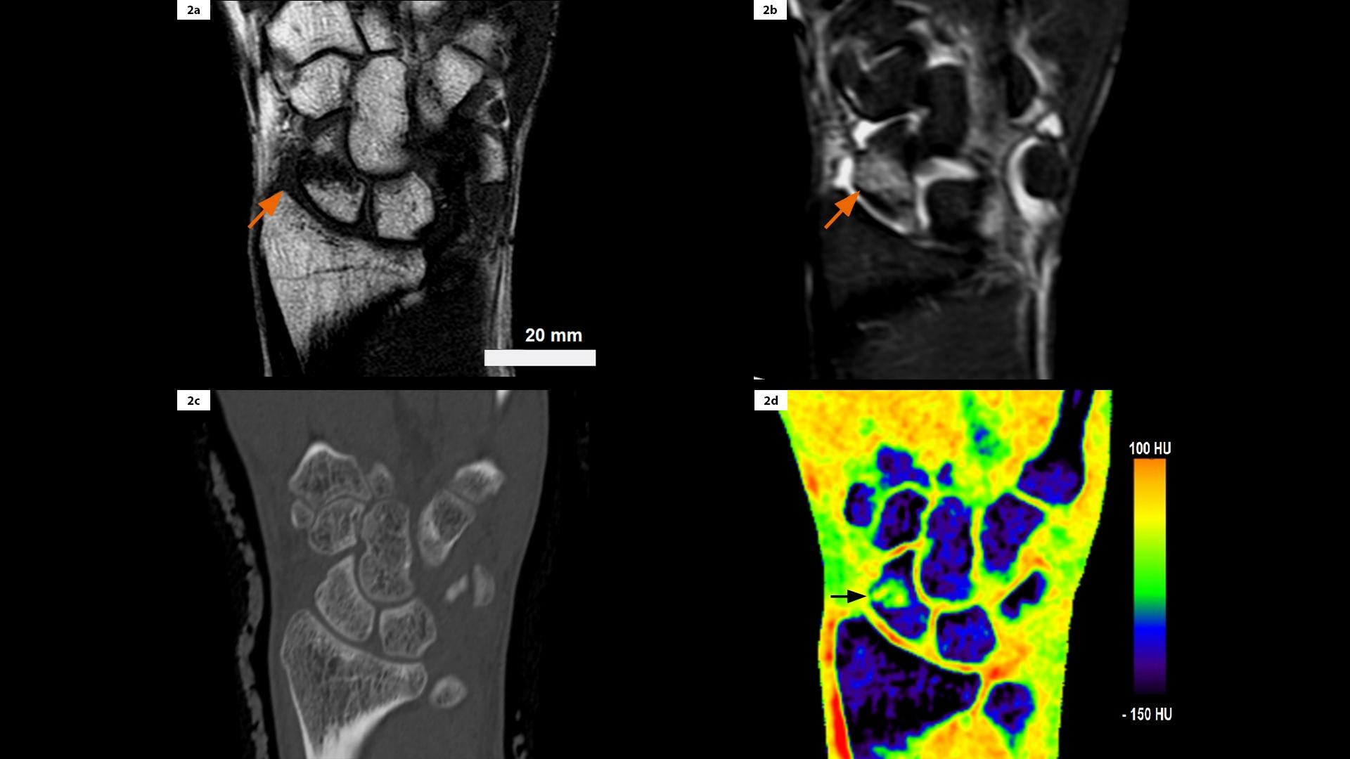 Scaphoid fracture associated bone marrow edema - Siemens Healthineers ...