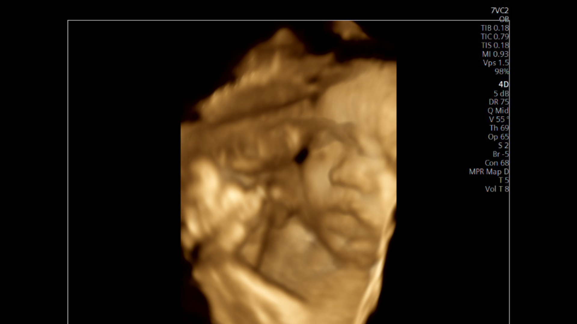 ACUSON Redwood Ultrasound System - Siemens Healthineers