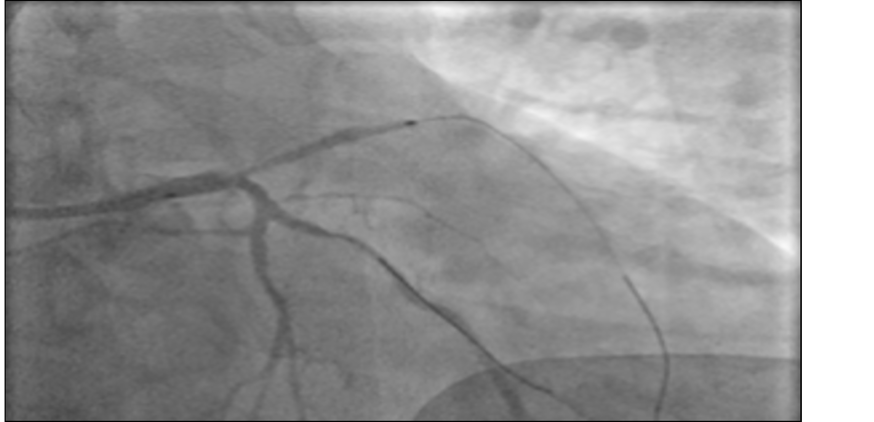 Enhanced stent visualization assists in improving the outcome of ...