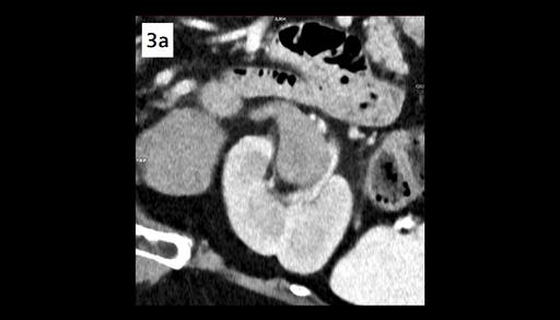 Severe ureteral obstruction secondary to an upper urinary tract ...