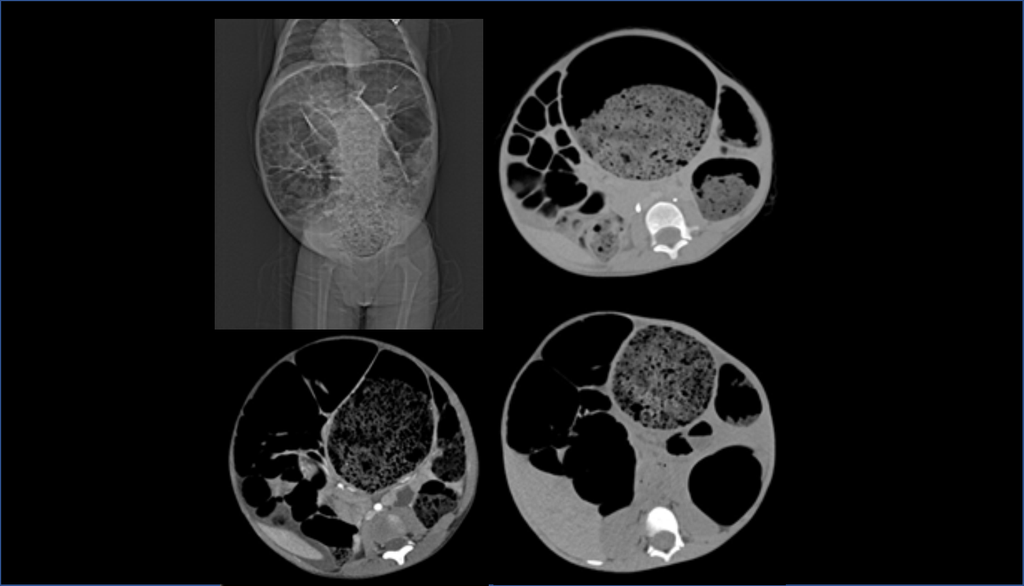 Hirschsprung’s Disease (HD) - Congenital Megacolon Child Imaging with ...