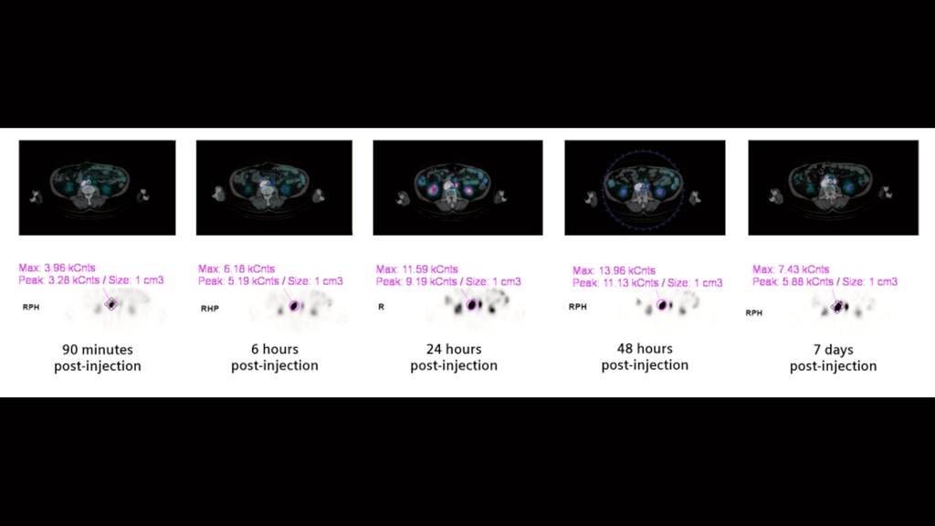 Tumor and organ dosimetry from sequential quantitative SPECT/CT - Siemens Healthineers Romania