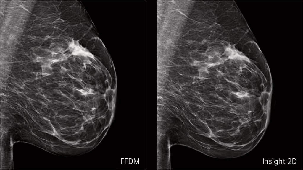 High Definition Breast Tomosynthesis – Siemens Healthineers - Siemens ...