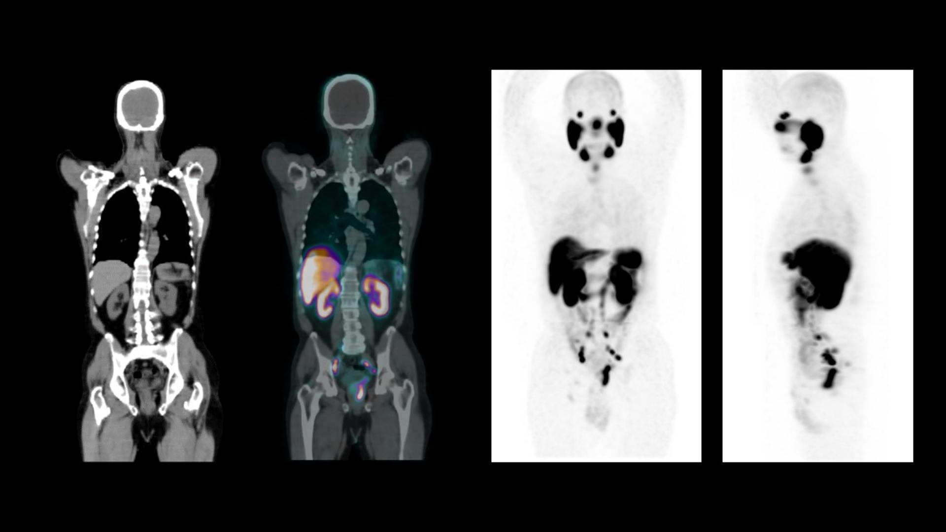 A comparative analysis of 99mTc-iPSMA SPECT/CT and 18F-PSMA-1007 PET/CT Siemens Healthineers ...