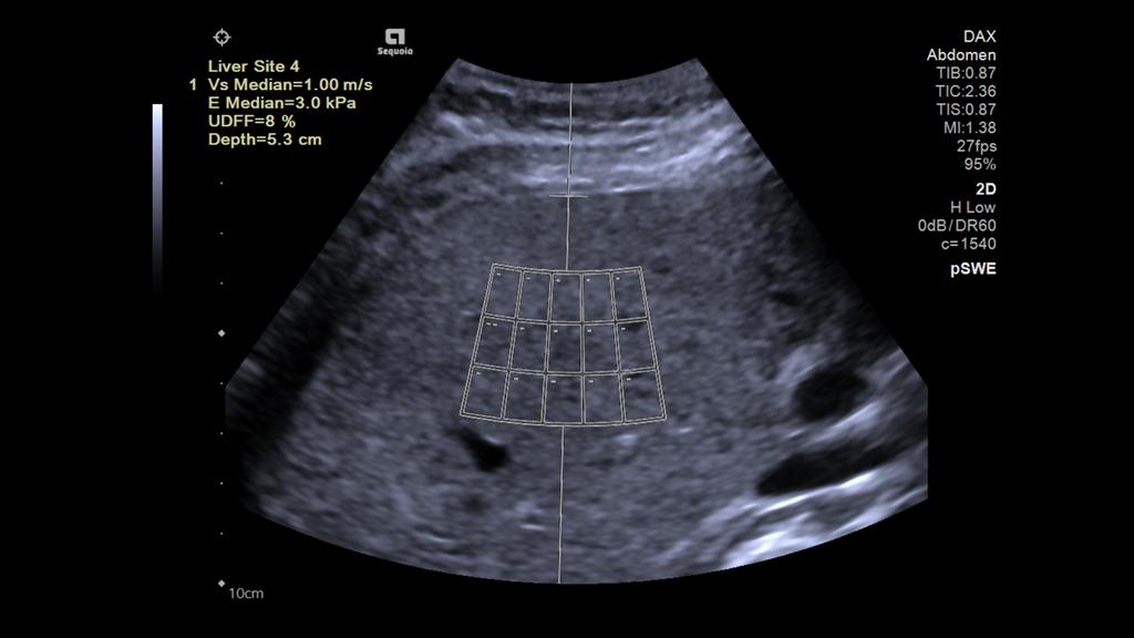 Acuson Sequoia Ultrasound System Siemens Healthineers Usa