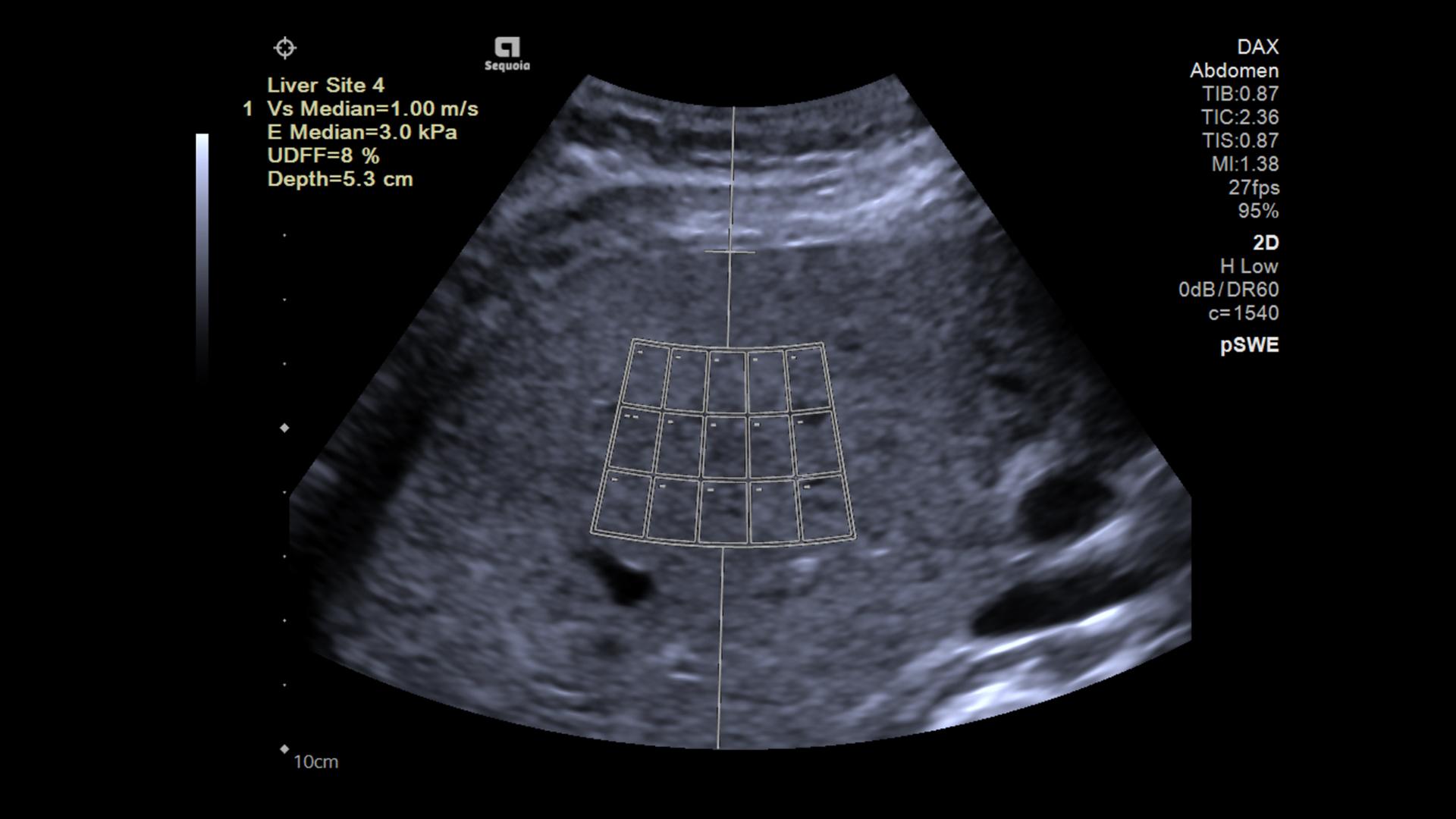 ACUSON Sequoia Ultrasound System - Siemens Healthineers