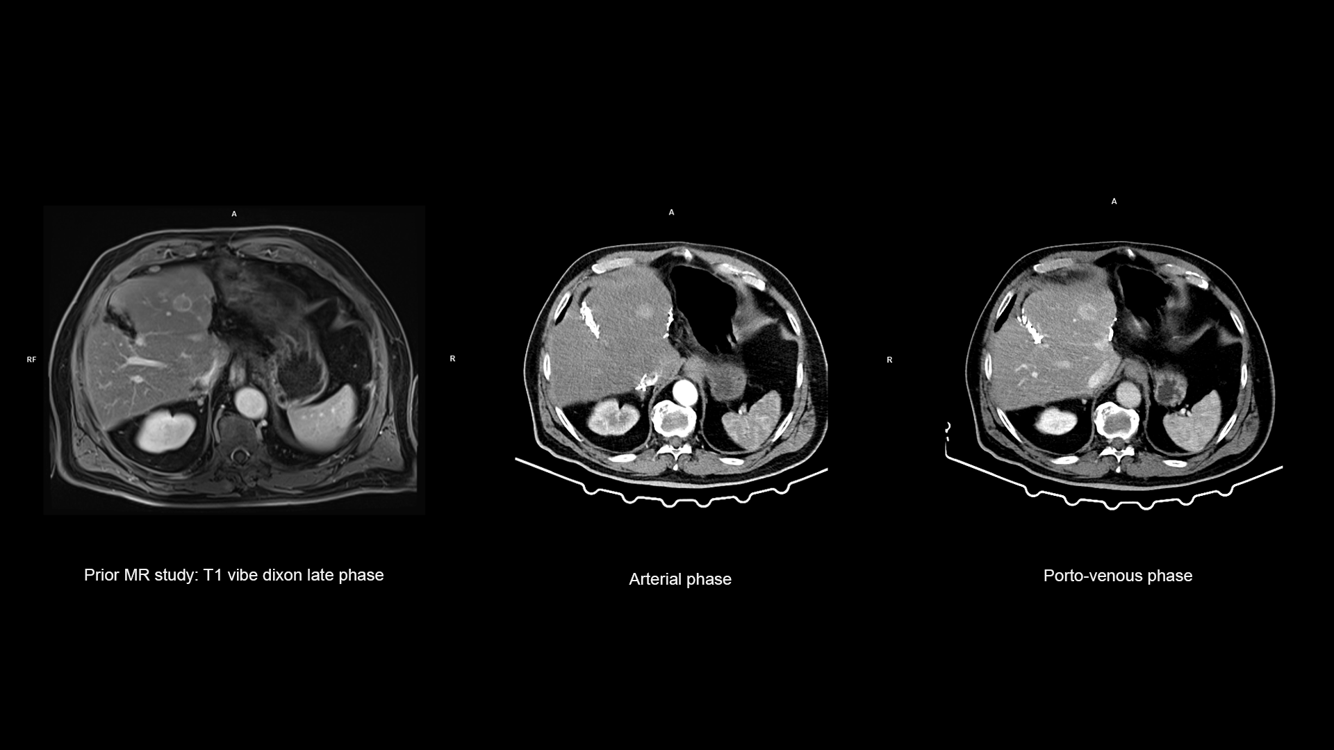 CT-guided interventional procedures on SOMATOM go.platform - Siemens ...