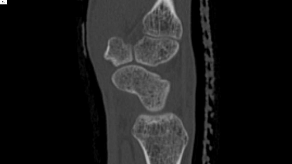 Scaphoid fracture associated bone marrow edema - Siemens Healthineers ...