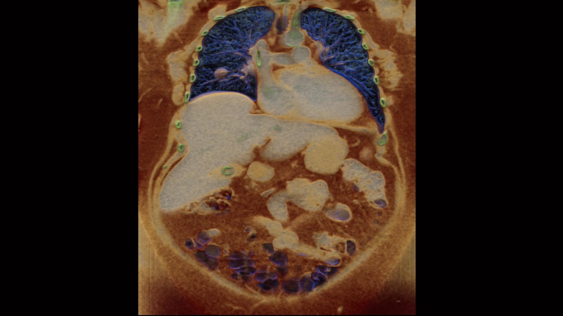 Computed Tomography - Siemens Healthineers