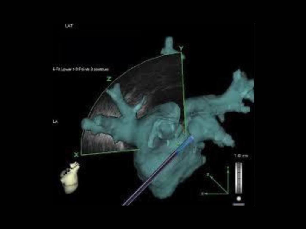 ACUSON AcuNav Volume 4D ICE Catheter - Siemens Healthineers USA