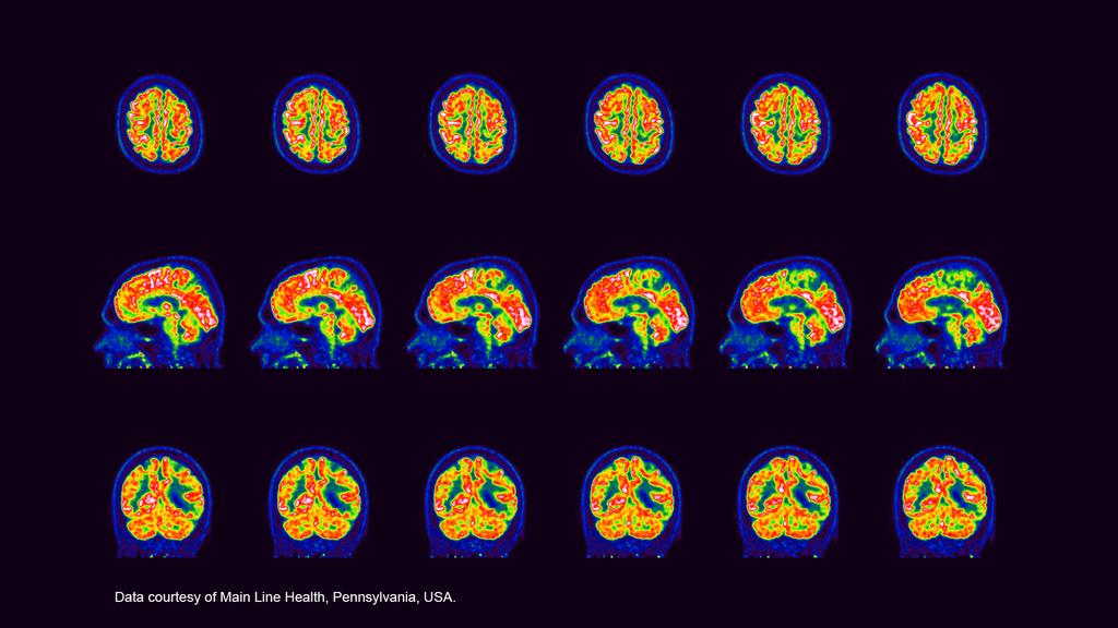 Beta-amyloid PET/CT imaging for Alzheimer's disease - Siemens ...