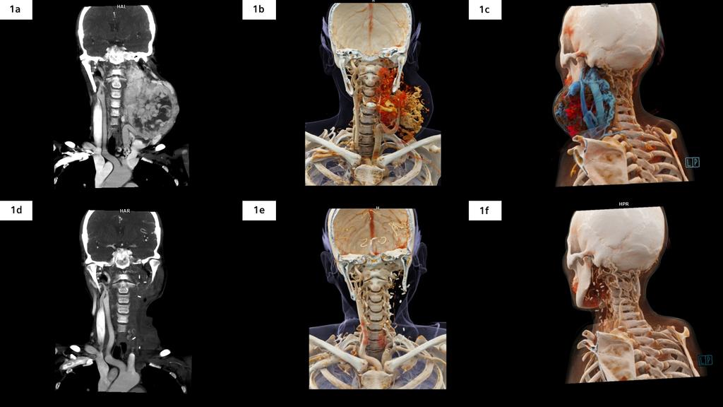 Massive carotid body tumor - Siemens Healthineers Vietnam
