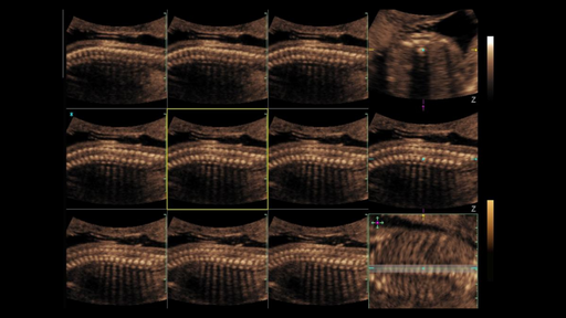 ACUSON Maple is a High-Performance Shared Service Ultrasound System ...