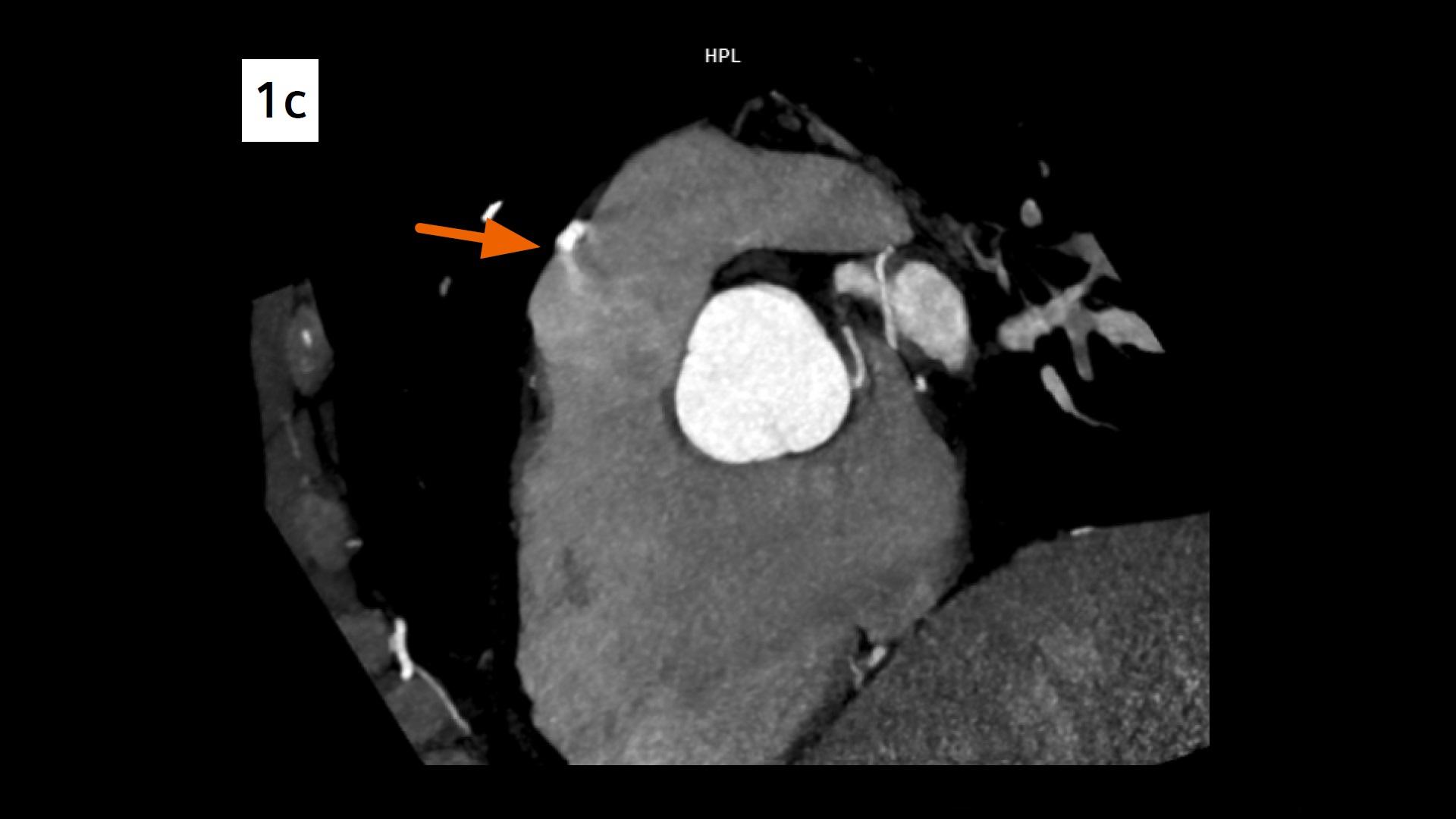 Complex Coronary Artery Fistulas & Aneurysm in an Asymptomatic Patient ...