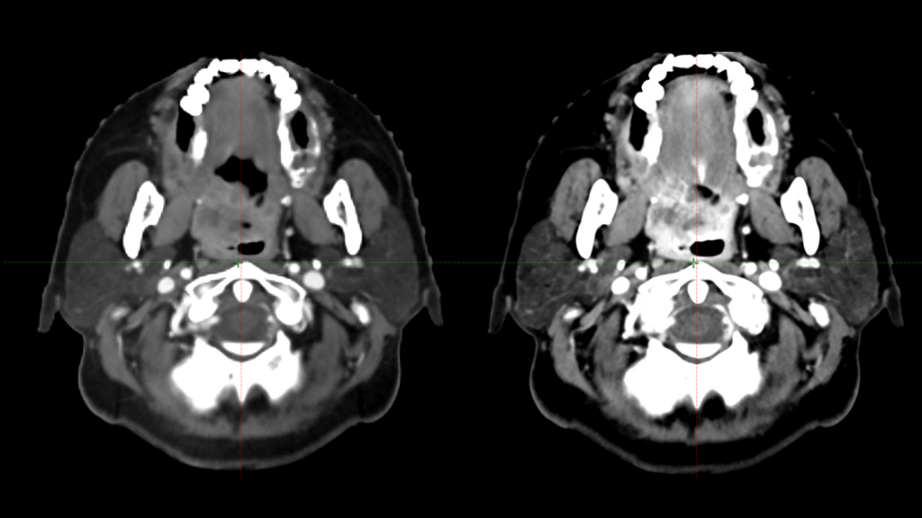 Diving Deeper: Adoption of Dual Energy CT Revolutionize Oncology Treatment
