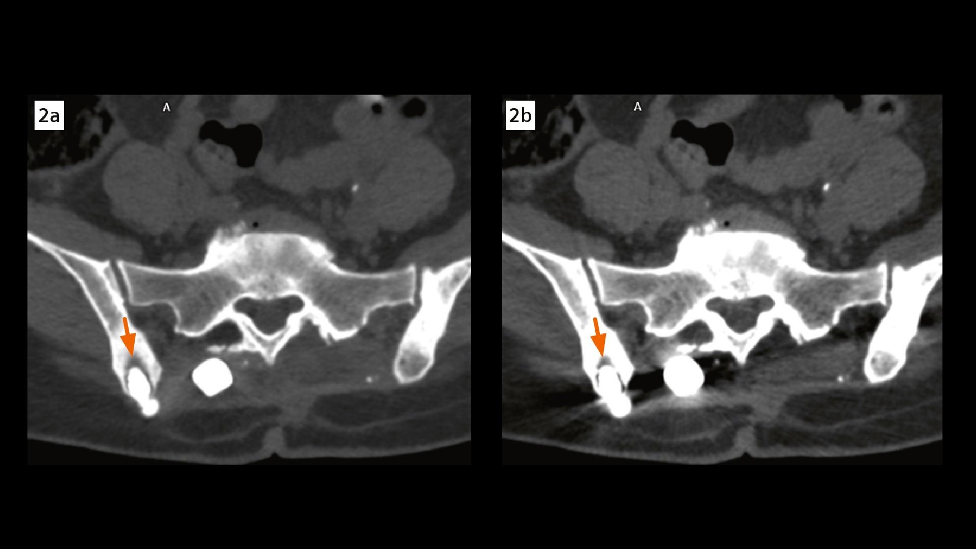 Osteosíntesis espinal complicada por osteólisis postoperatoria y ...