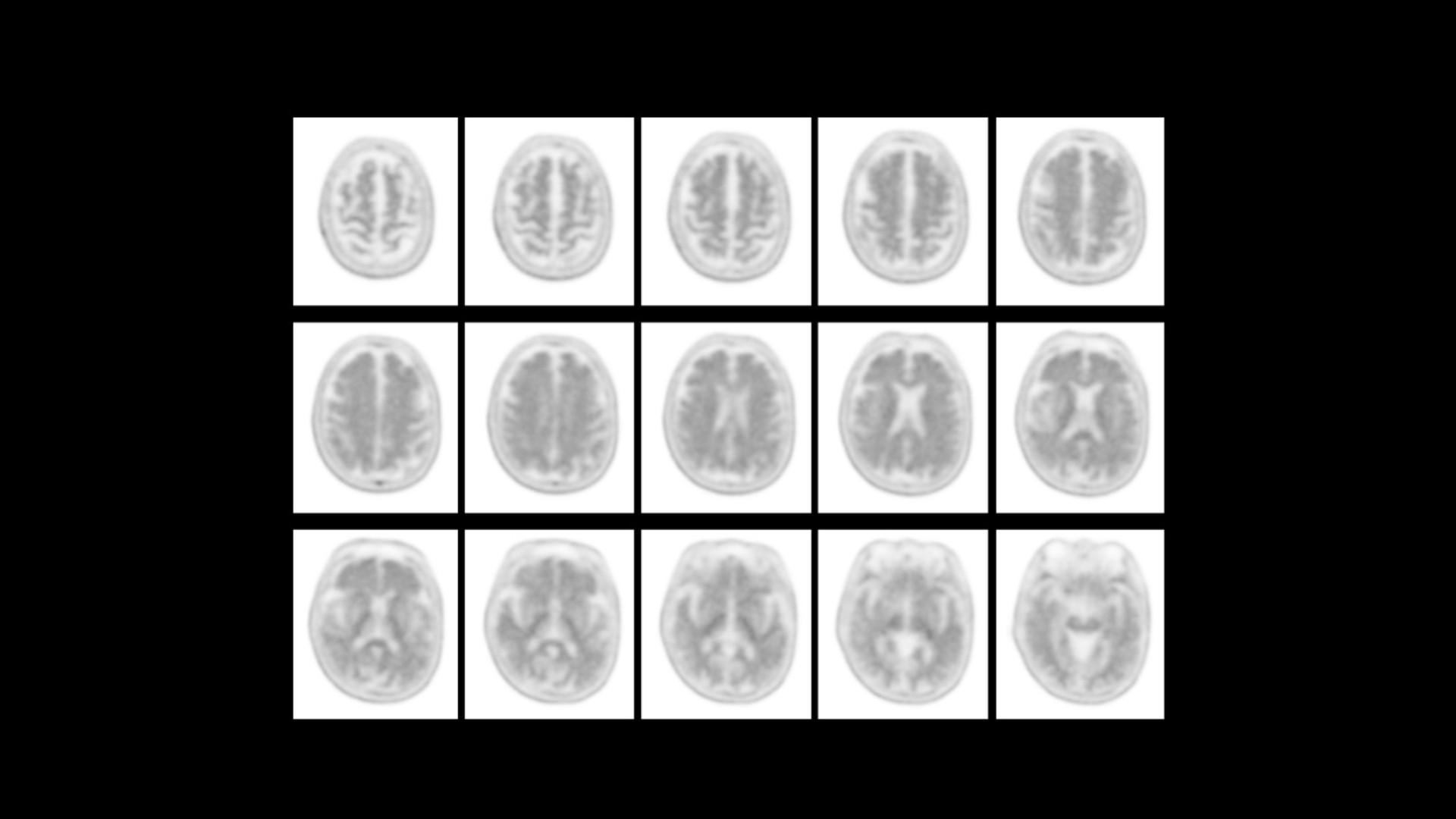 Biograph Trinion PET/CT scanner - Siemens Healthineers