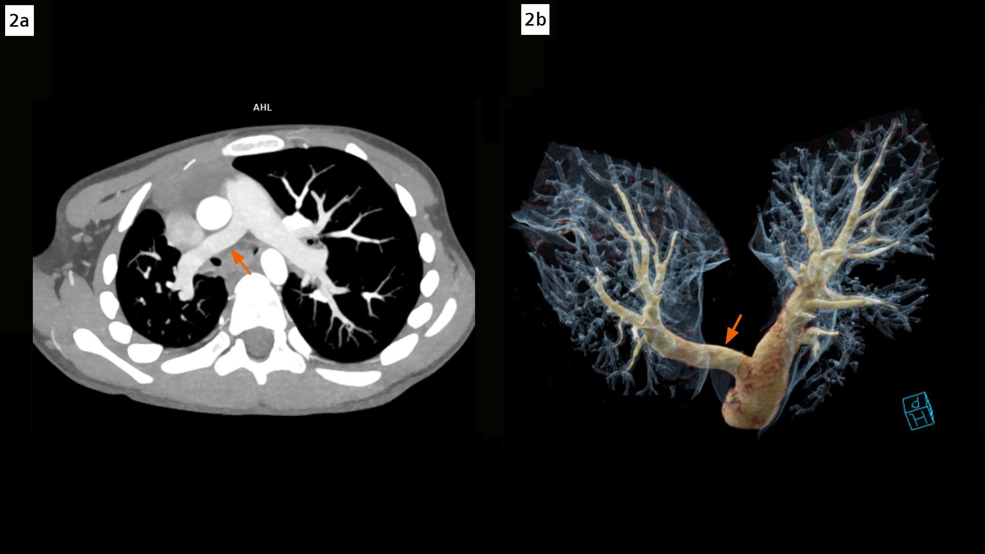 Scimitar syndrome - Siemens Healthineers