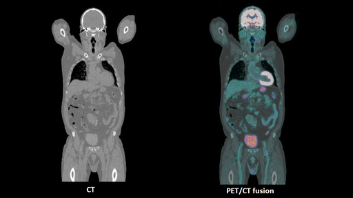 Biograph Vision PET/CT Scanner - Siemens Healthineers India