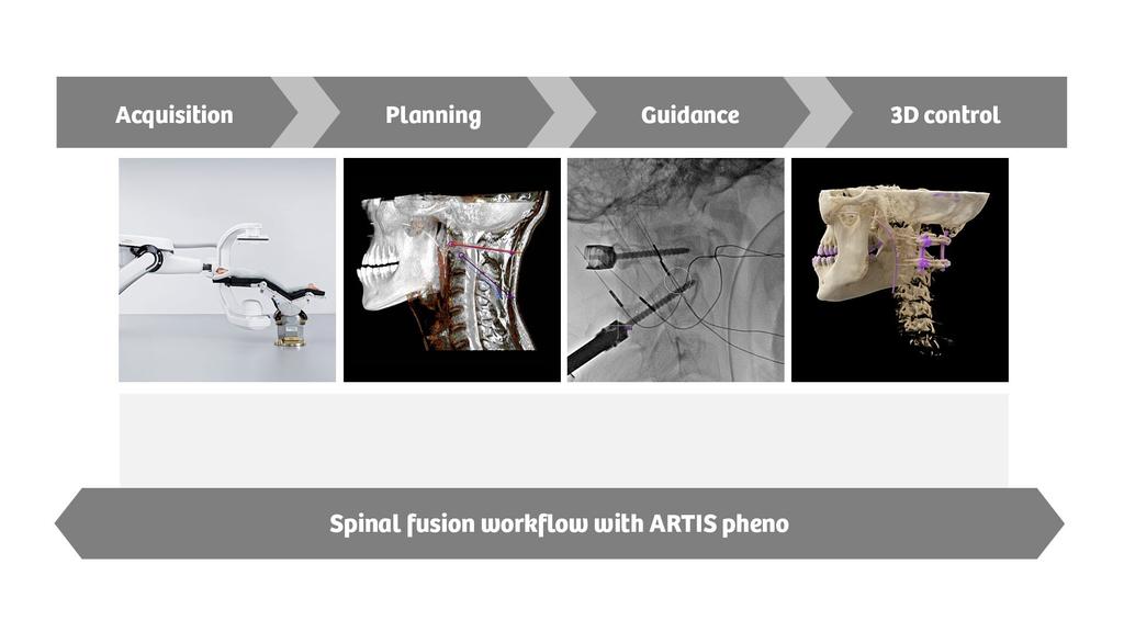 Spinal Fusion in the Hybrid OR - Siemens Healthineers