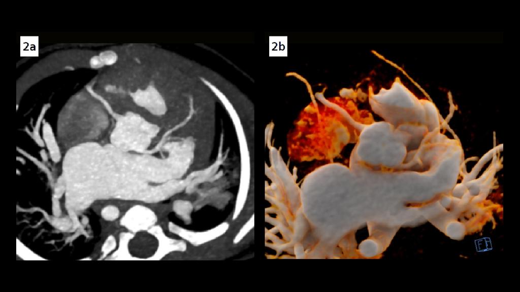 Preoperative evaluation in a case of Tetralogy of Fallot - Siemens ...