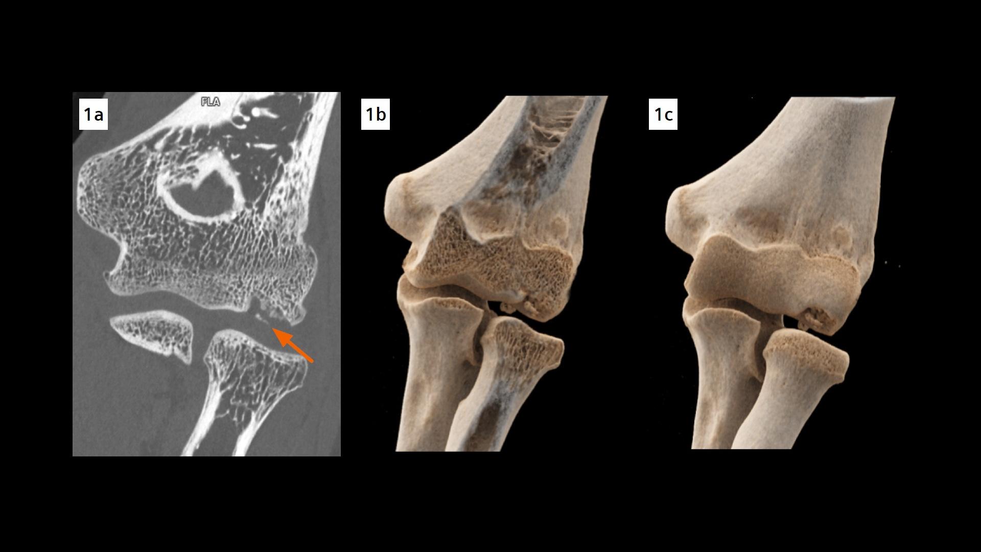 Osteochondritis dissecans of the capitellum - Siemens Healthineers