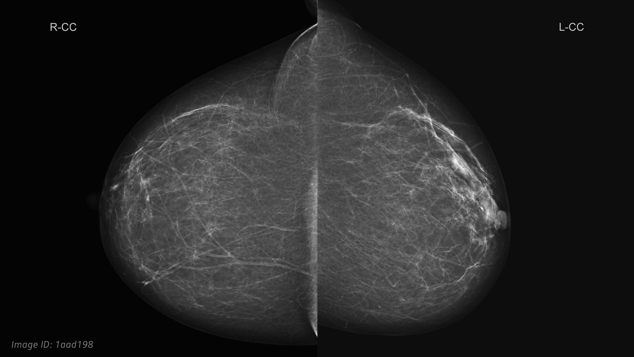 Better Care for More Patients with 50° Wide-Angle Tomosynthesis ...