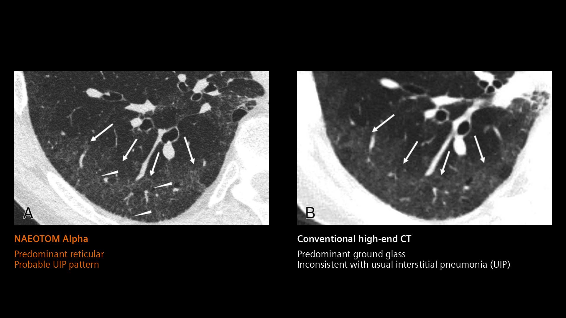 PCCT pulmonology imaging - Siemens Healthineers