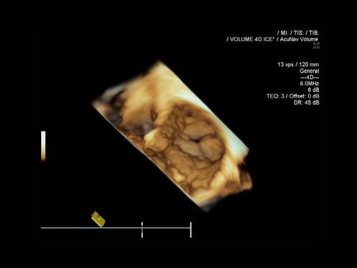 ACUSON AcuNav Volume 4D ICE Catheter - Siemens Healthineers USA