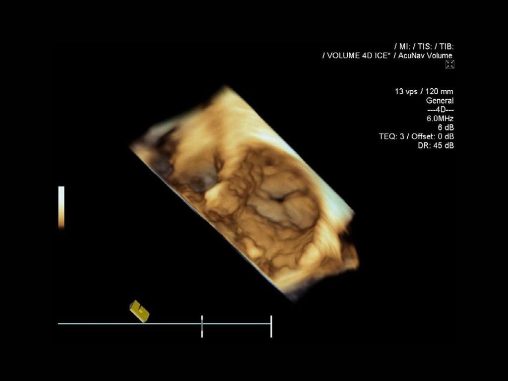 ACUSON AcuNav Volume 4D ICE Catheter - Siemens Healthineers USA