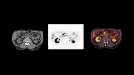 Single-bed, whole-body 68Ga DOTATATE PET/CT delineation of ...
