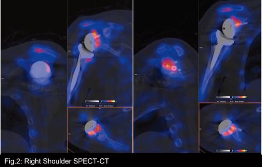 How SPECT-CT helps to clarify severe pain, 1 year after shoulder ...