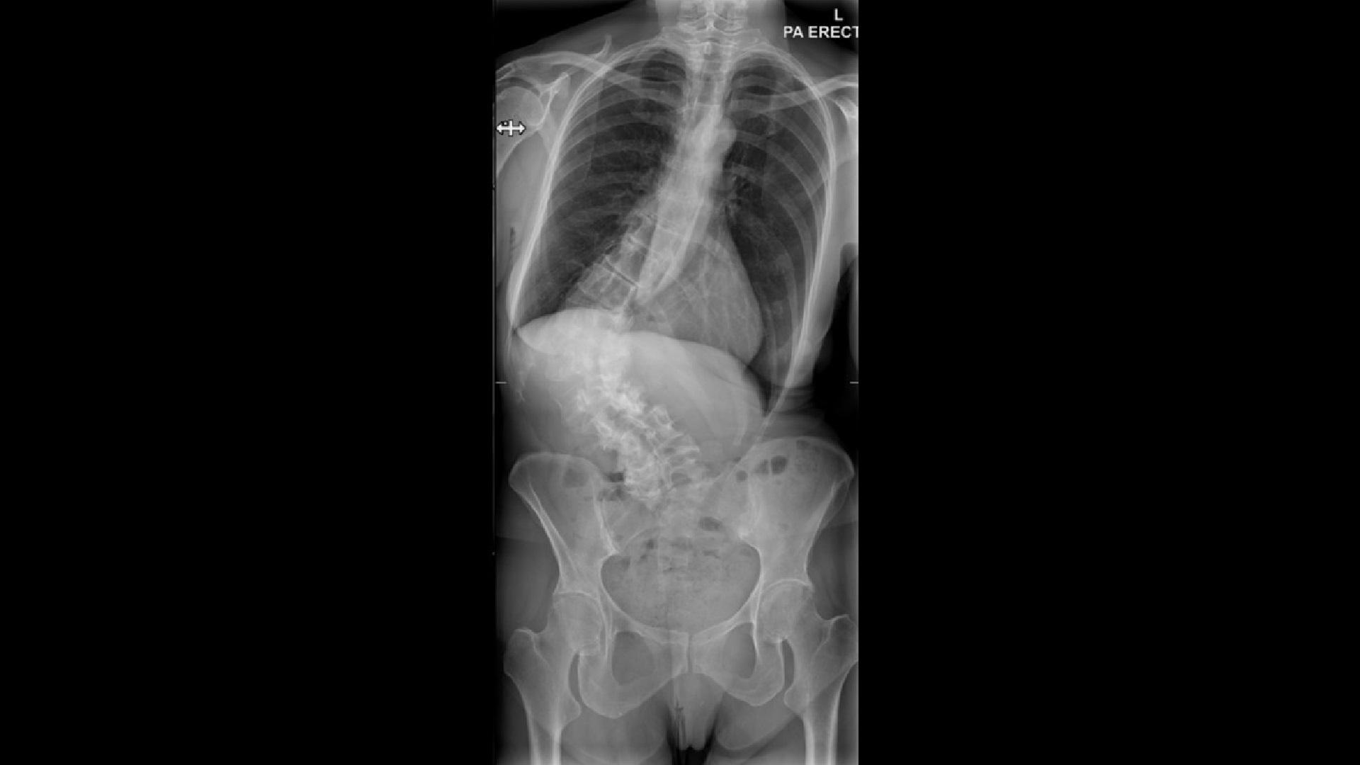 Twin Robotic X-ray scanner – Multitom Rax - Siemens Healthineers USA