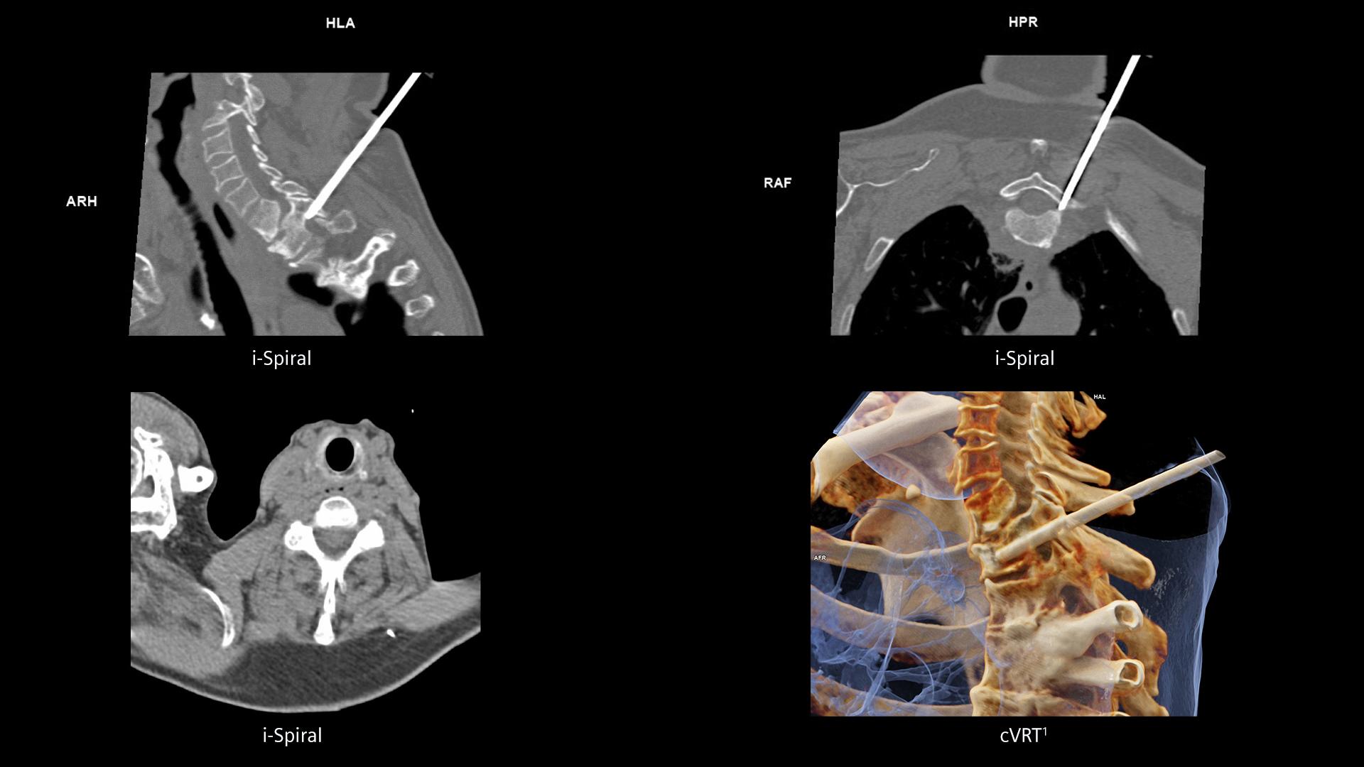 CT-guided interventional procedures - Siemens Healthineers
