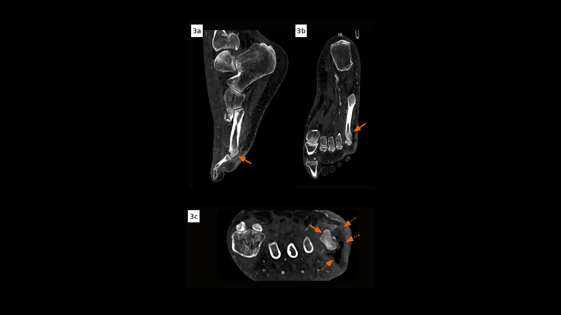 Diabetic foot syndrome - Siemens Healthineers España