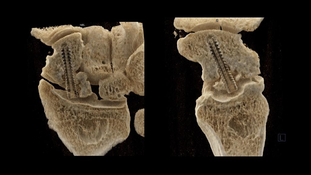 FOOSH injury with screw fixation of the scaphoid - Siemens Healthineers