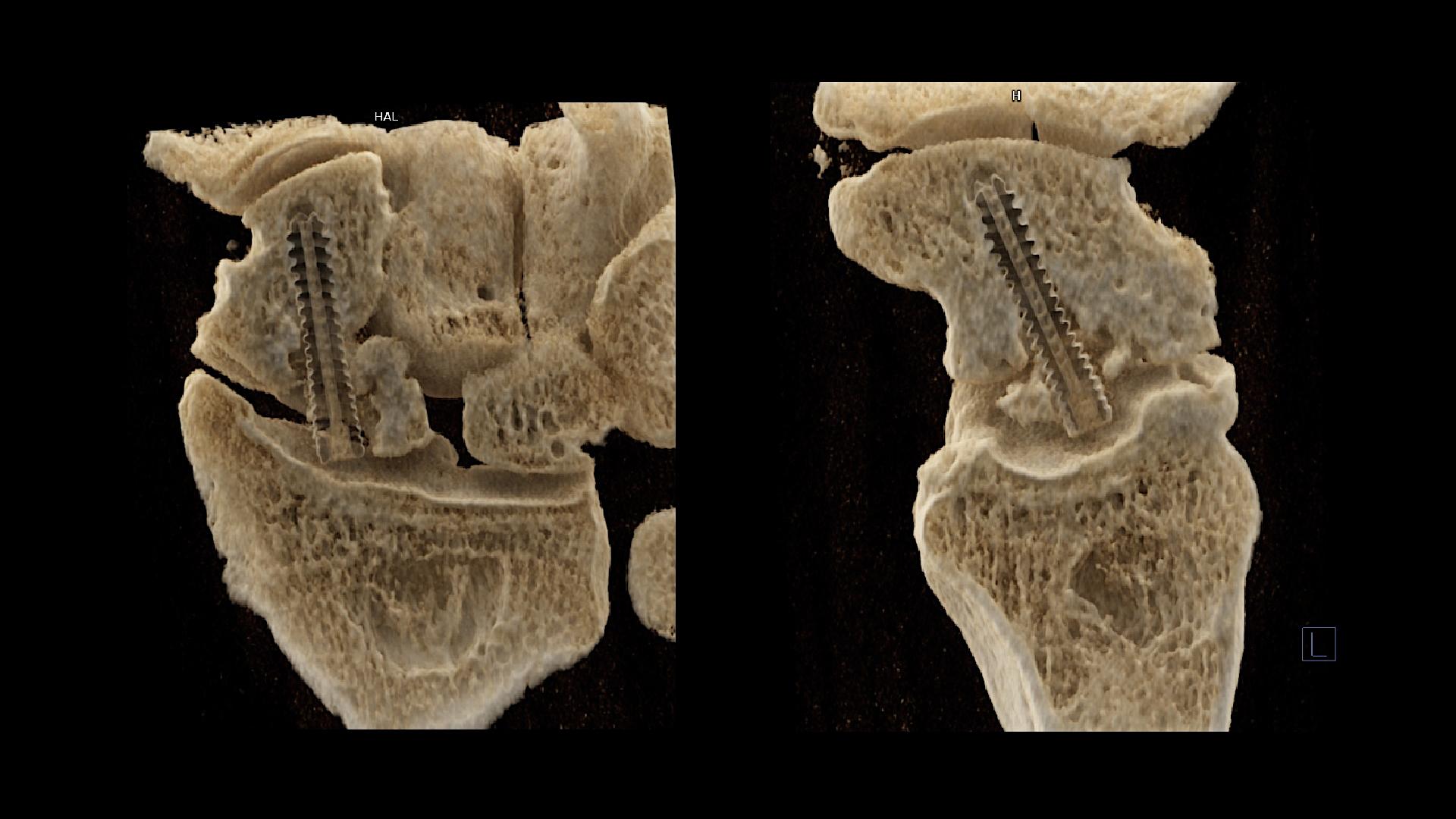 Inside An Incidental Solid Renal Mass Siemens Healthineers