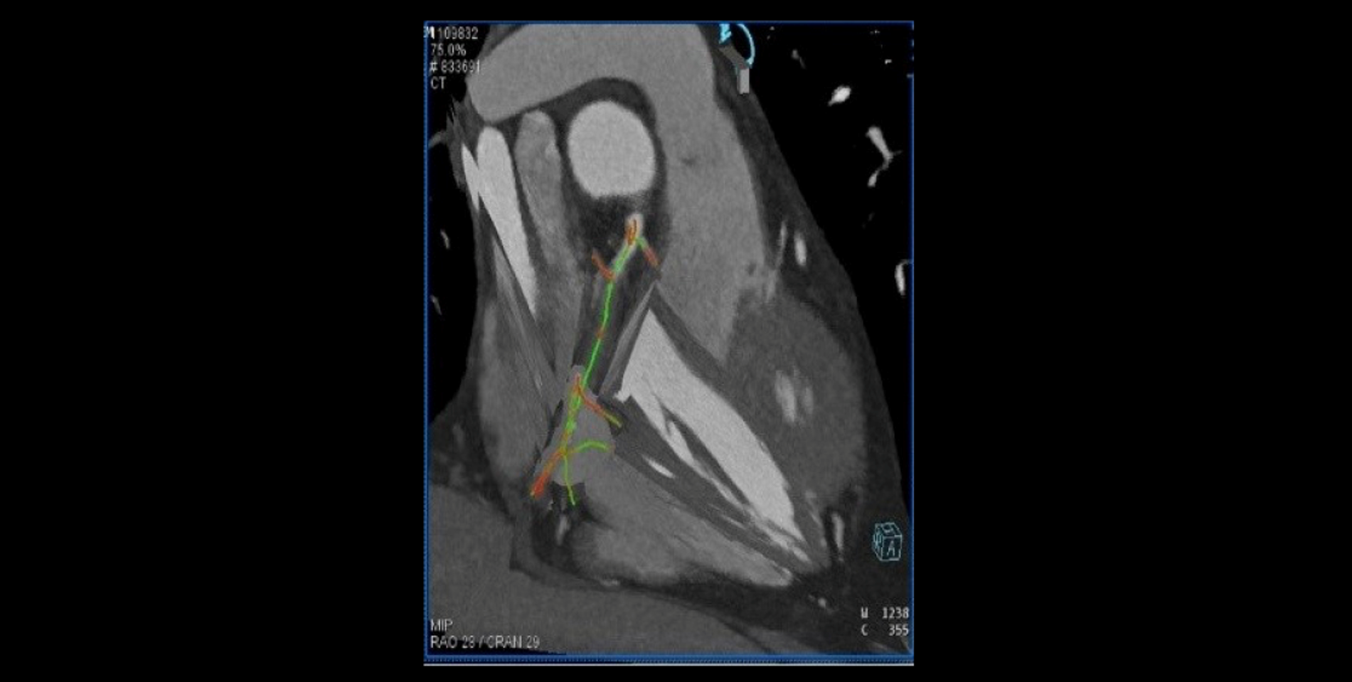 Multimodality Imaging in the Cath Lab for Guidance During CTO Treatment