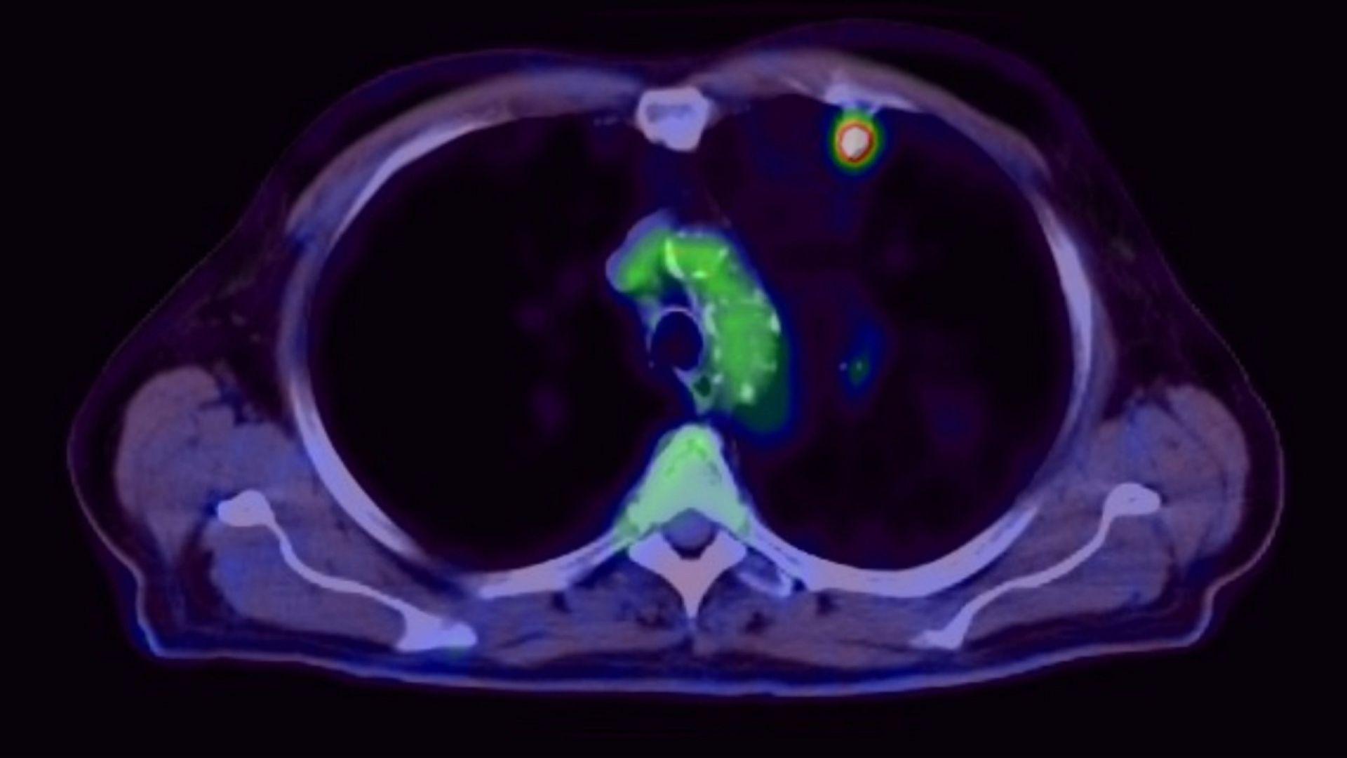 Bringing Intelligence To The Cancer Care Continuum - Siemens ...