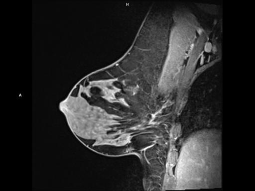 NeoCoil - Siemens Healthineers USA