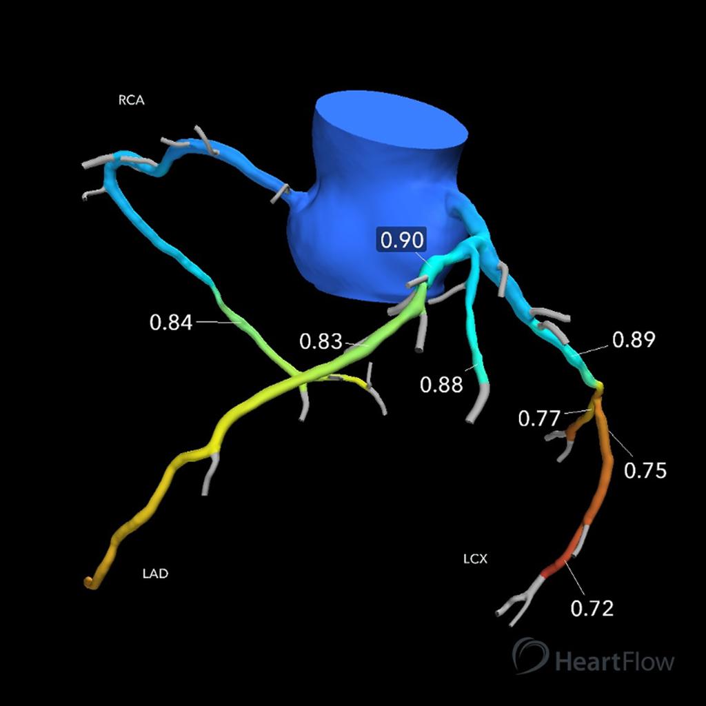 Rethink FFR assessment for every patient - Siemens Healthineers
