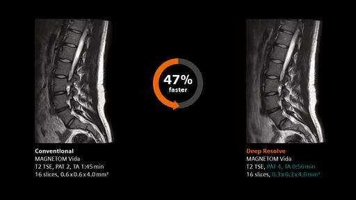 Deep Resolve - Siemens Healthineers