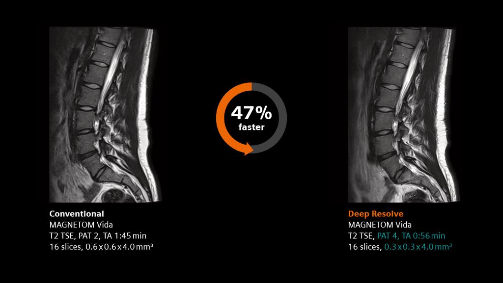 Deep Resolve - Siemens Healthineers