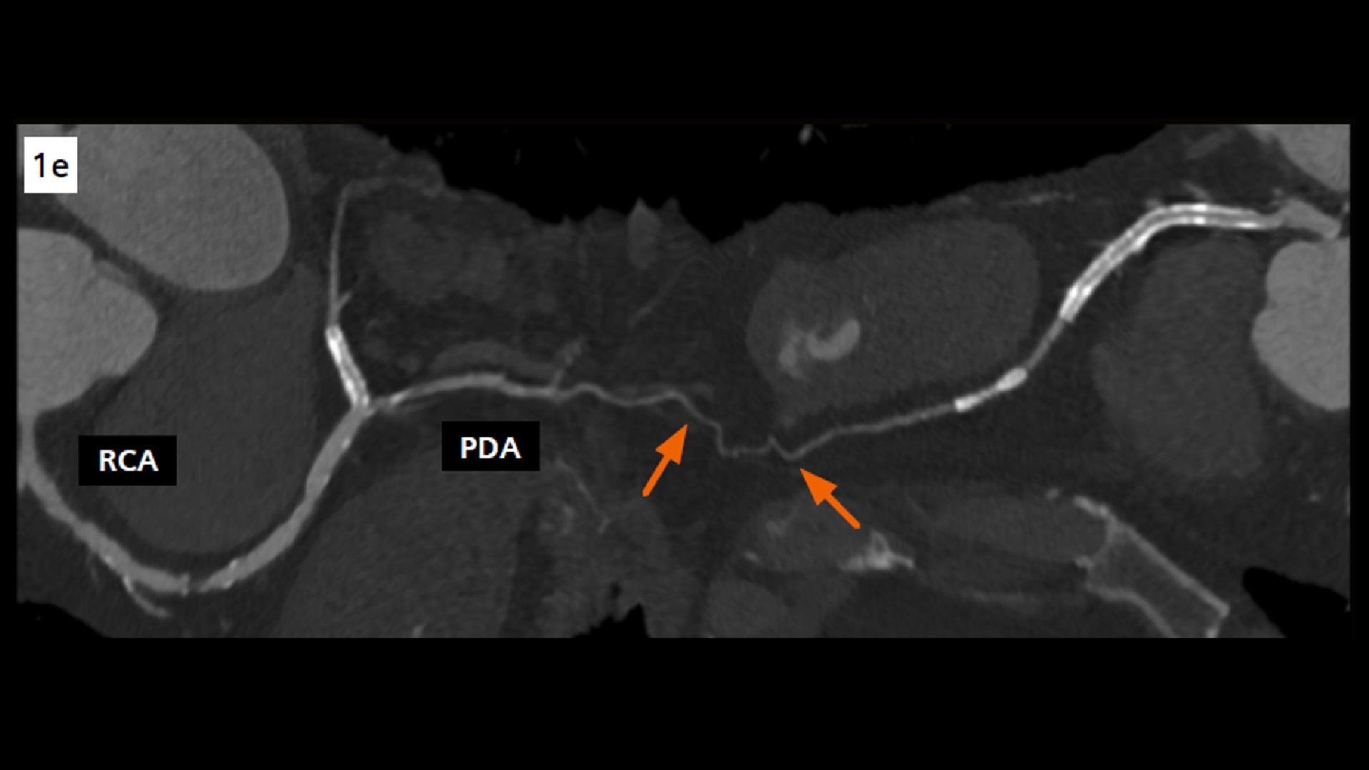 Triple-Vessel Coronary Disease With Multiple Stents - Siemens ...